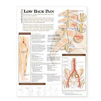 Understanding Low Back Pain Anatomical Chart - Autres - Achat Livre | fnac
